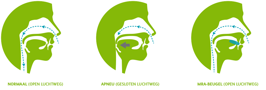 MRA-therapie bij Slaapapneu - Vivisol Nederland